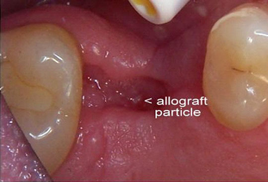 Allograft Histology | SteinerBio