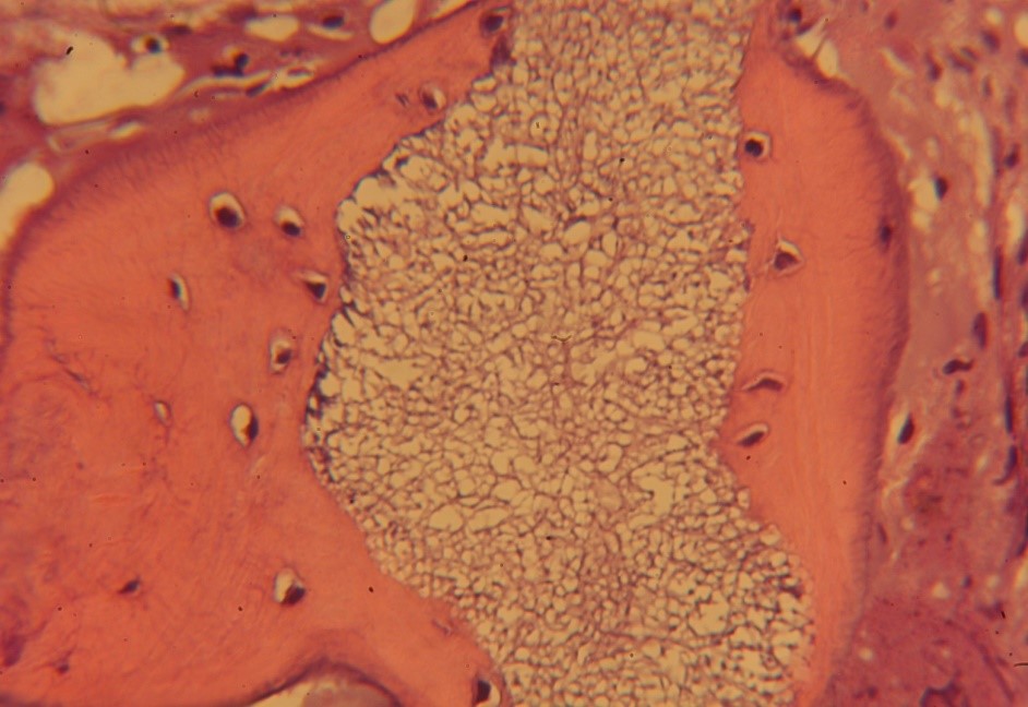 What is a Bone Graft?