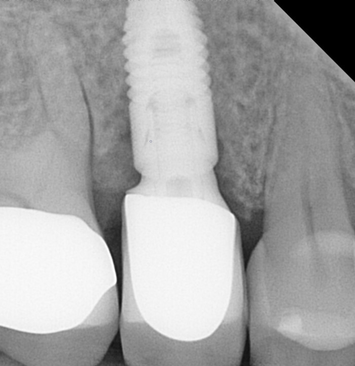 SteinerBio™ | Sutureless Socket Membranes with Oral Bond