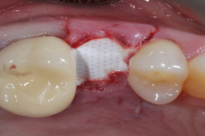 SteinerBio™ | Sutureless Socket Membranes with Oral Bond