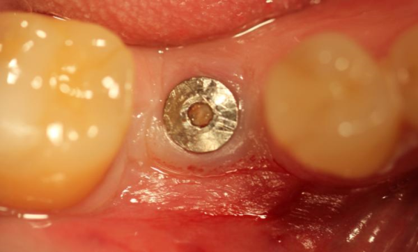 Diagnosing and Treating a "Hollow Jaw" | SteinerBio