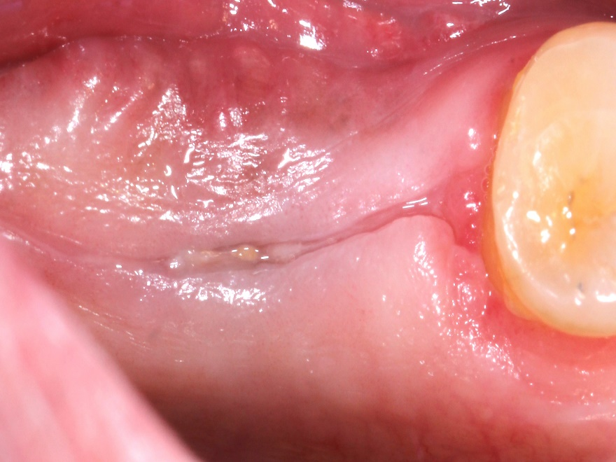 SteinerBio™ | Simple Ridge Augmentation