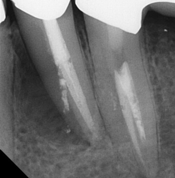 Grafting Severely Damaged Sockets: Socket Graft Plus