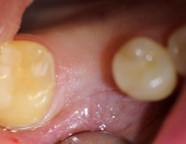 Diagnosing and Treating a "Hollow Jaw" | SteinerBio