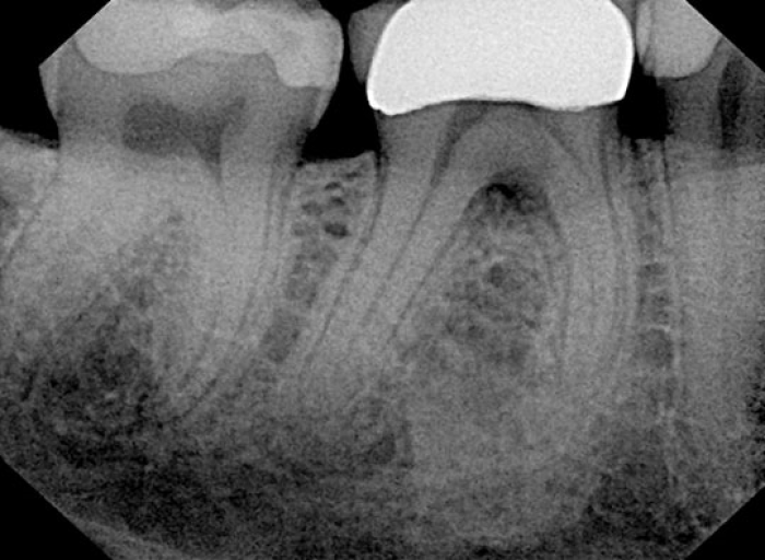 Regenerating Class II Furcations | SteinerBio