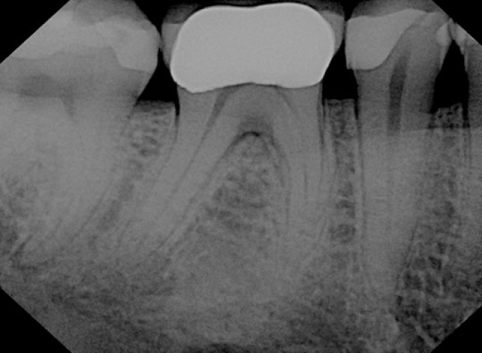 Regenerating Class II Furcations | SteinerBio