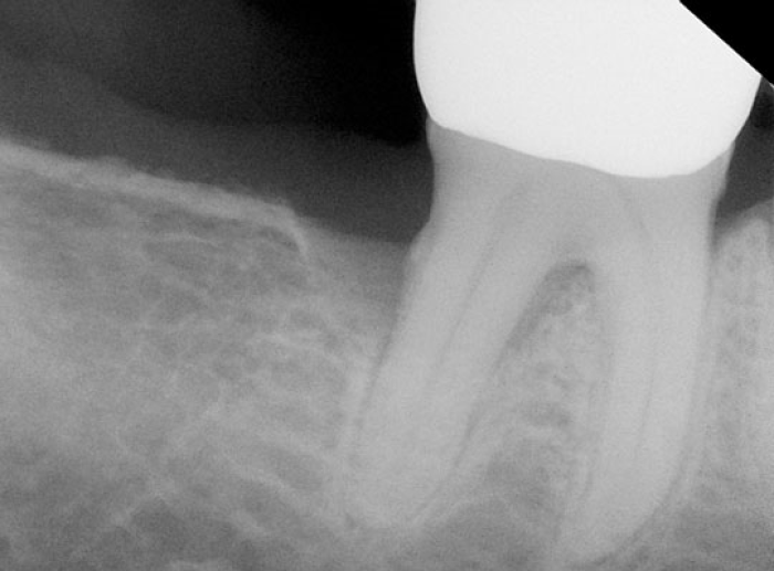 Regenerating Class II Furcations | SteinerBio