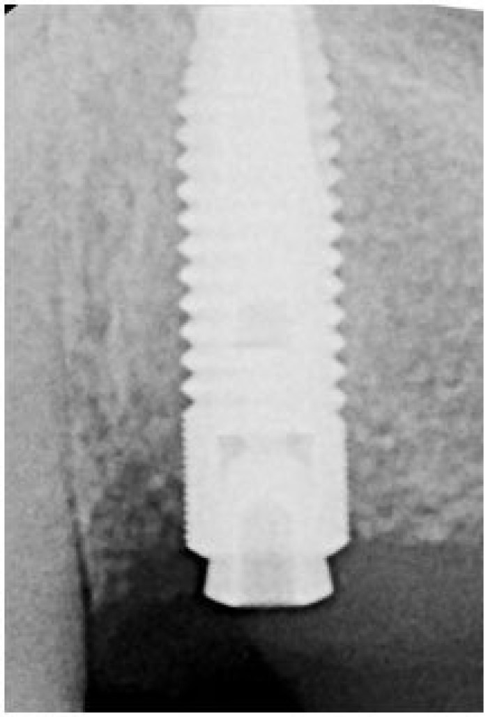 Socket Graft Cases with Histology | SteinerBio