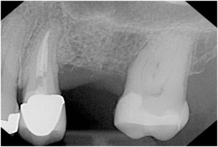 Socket Graft Cases with Histology | SteinerBio