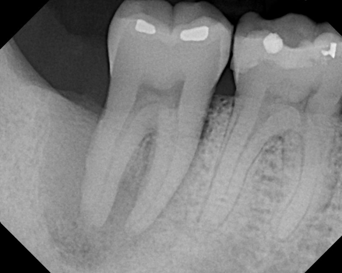 Treating a Profusely Bleeding and Infected Socket | SteinerBio