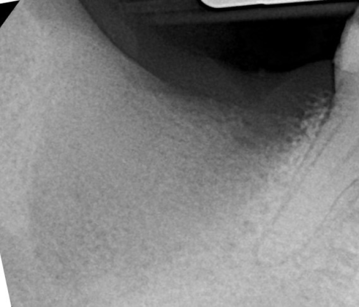 Treating a Profusely Bleeding and Infected Socket | SteinerBio