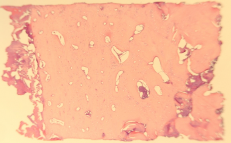 How the Immune System Determines Bone Graft Success or Failure ...