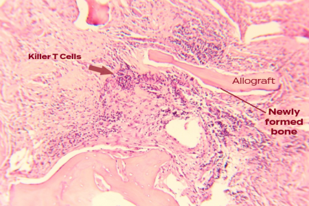 How the Immune System Determines Bone Graft Success or Failure ...