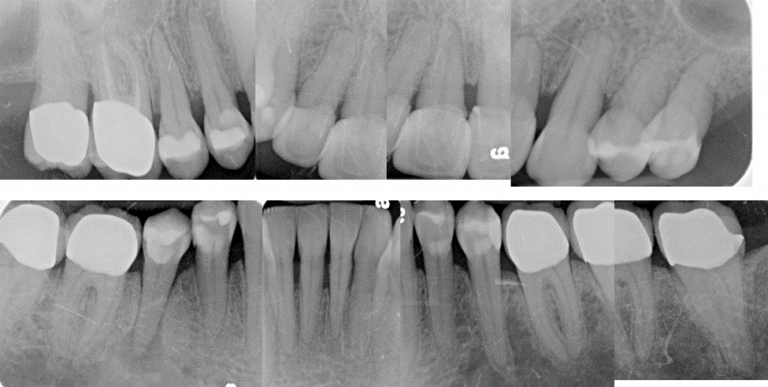 The Periosteum for Regenerating Periodontal Lesions