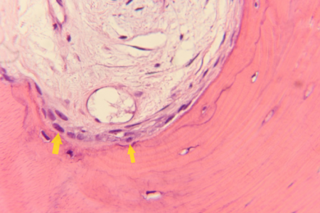 Understanding Sclerotic Bone | SteinerBio™