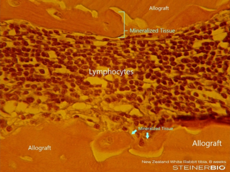 Understanding Sclerotic Bone | SteinerBio™