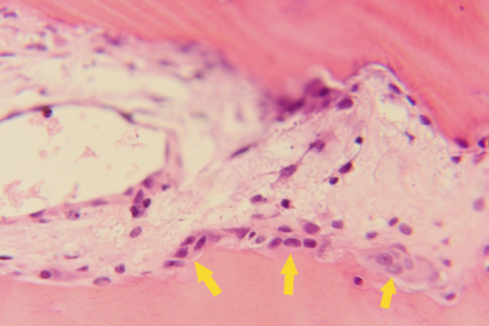 Understanding Sclerotic Bone | SteinerBio™