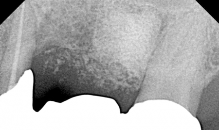 Understanding Sclerotic Bone | SteinerBio™