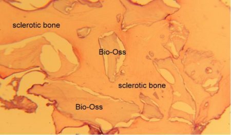 Understanding Sclerotic Bone | SteinerBio™