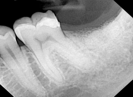 Understanding Sclerotic Bone | SteinerBio™