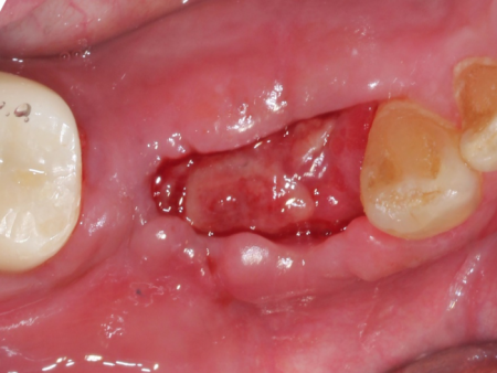 Ridge Augmentation and the Etiology of Buccal Alveolar Resorption ...