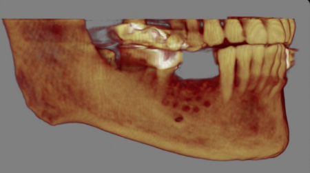 Ridge Augmentation and the Etiology of Buccal Alveolar Resorption ...