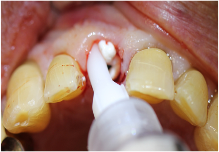 Atraumatic Tooth Extraction to Avoid Bone Resorption