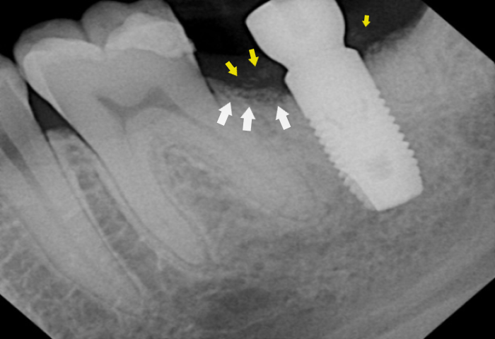 The Science Behind Dental Implant Loss and Bone Graft Failure