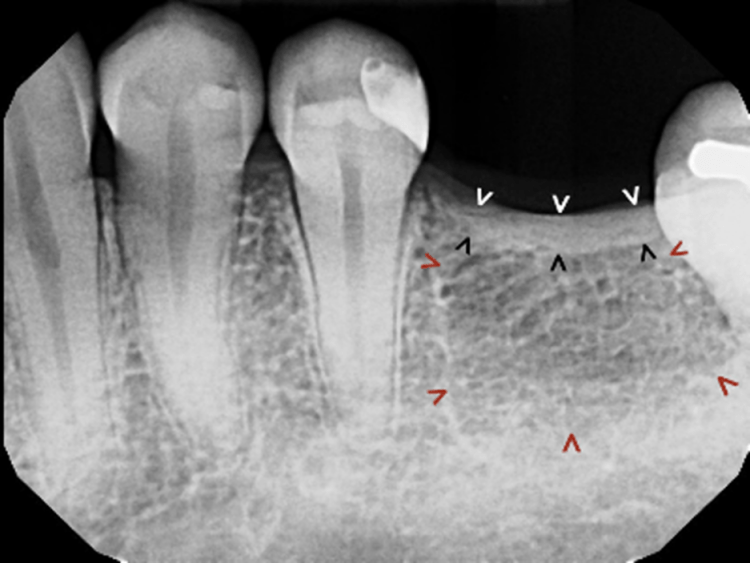 Are Dental Cavitations Real? Understanding Jawbone Lesions and Treatment
