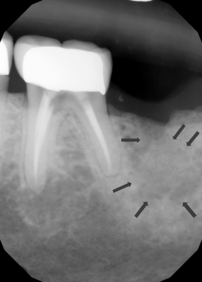 Are Dental Cavitations Real? Understanding Jawbone Lesions and Treatment