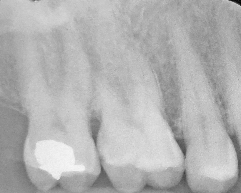 Long Term Ridge Preservation | SteinerBio